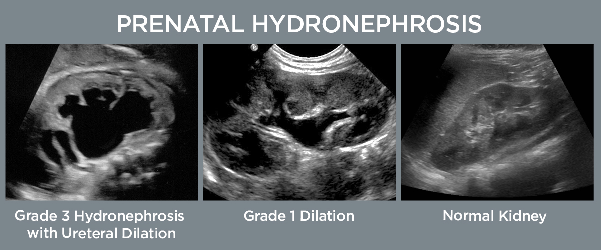 Mild Hydronephrosis Ultrasound