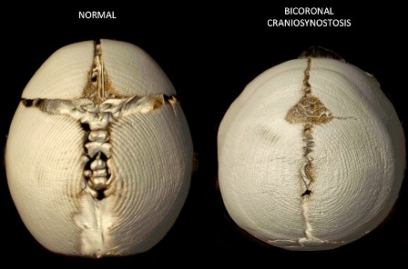Bicoronal Synostosis
