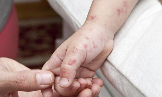 Shingles in Children | Chickenpox & Shingles | Children’s Health