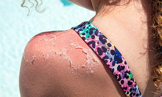 How to prevent and treat sunburn in kids – Children’s Health