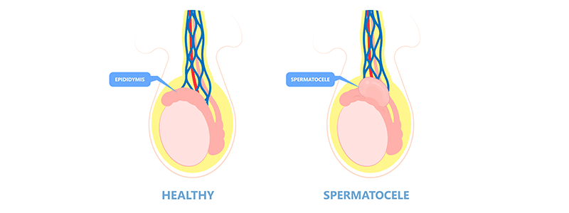 Incidentally Detected Epididymal Cysts And Spermatoceles Sarah