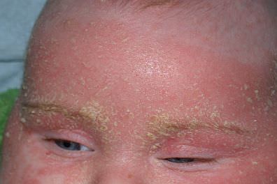 Infantile Seborrheic Dermatitis Face